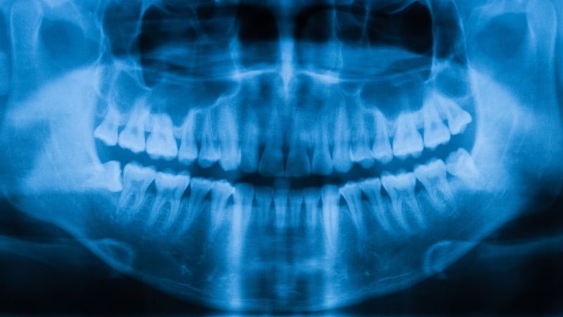 Ai Can Detect Patients Sex With Almost 100 Accuracy Just From X Ray